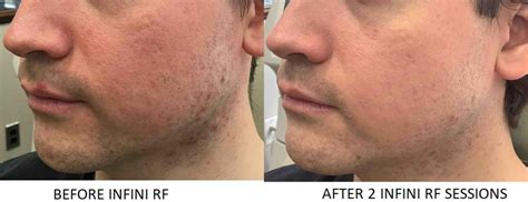 Genius Rf Microneedling Before And After Photo Gallery Washington Dc