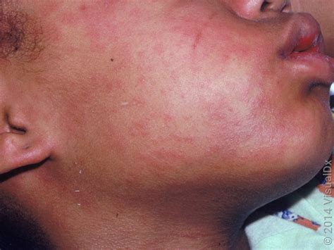 Rubella Vs Rubeola Measles Differences Photos And More Goodrx