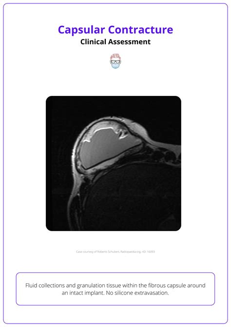Capsular Contractureaetiology Classification And Management