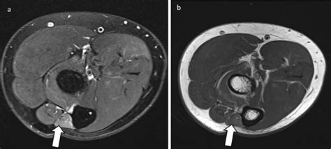 Entrapment Of The Radial Nerve Pacs
