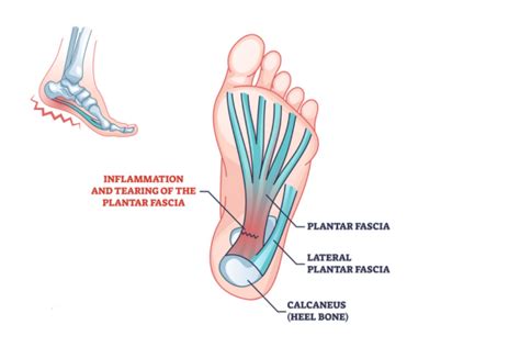 What Is Plantar Fasciitis And How Can You Treat It Bodi