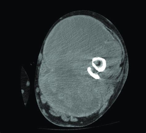 Axial Computed Tomography Ct Scan Showing The Soft Tissue Mass Almost