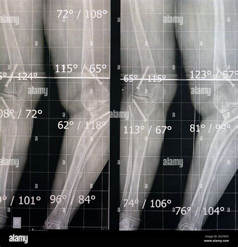 Migration Of Broken Tibia Plateau Screws