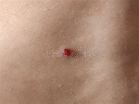 Surgical Removal Of Pyogenic Granuloma On Skin Stock Image Image Of