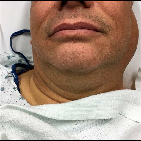 Photograph Showing Left Mandibular Swelling With Mild Tenderness And