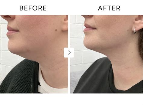 Restore Before And After Hifu Non Surgical Skin Tightening At Its
