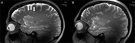 A Punctate Deep White Matter Hyperintensities Wmh Arrows On Download Scientific Diagram