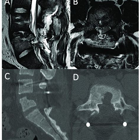 Aospine Classification System Of Thoracolumbar Spinal Fractures