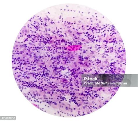 자궁 경부 세포진 얼룩 초기 위축성 변화와 함께 염증성 도말을 보여주는 자궁 경부 세포진 검사의 현미경 검사 전무 자궁 경부암 진단 0명에 대한 스톡 사진 및 기타 이미지