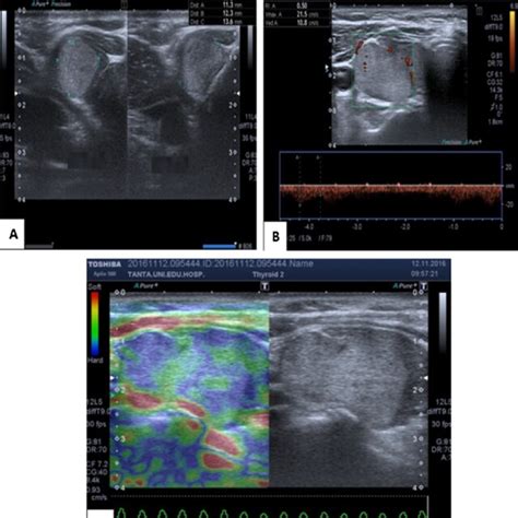 Thyroid Nodule Echogenicity In Histologically Proven Thyroid Nodule