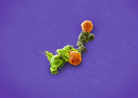 自然杀伤细胞（nk）——恶性血液瘤、实体瘤、病毒及真菌感染治疗的未来方向 知乎