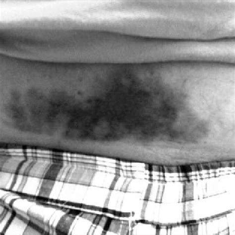 Maculopapular Rash Involving The Abdomen Download Scientific Diagram