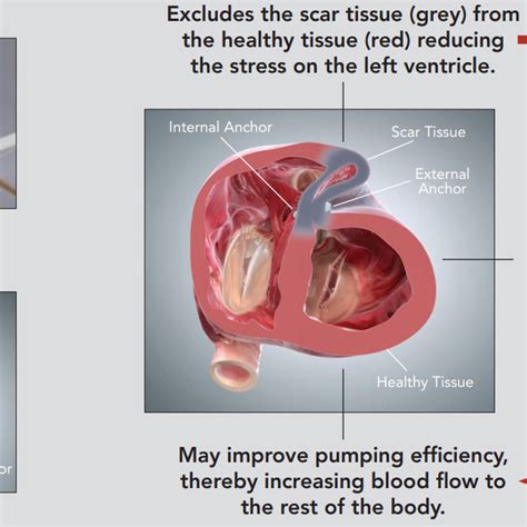 graphical illustration summarizing the revivent tc tm anchor system for