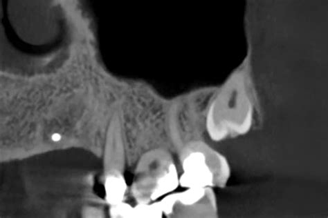 Lateral Block Augmentation In The Posterior Maxilla With Cancellous Maxgraft® Block Botiss