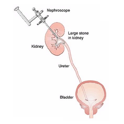 Mini Percutaneous Nephrolithotomy Advin Urology
