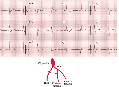 11 Bifascicular Block Right Bundle Branch Block [rbbb]