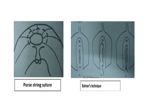 Types Of Suture Used In Different Region Of Pptx