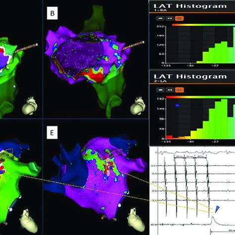 A Local Activation Time Lat Map Of The Right Atrium During Atrial