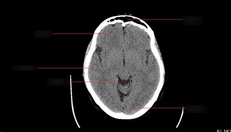Diagram Of Skull Mri 1 Quizlet