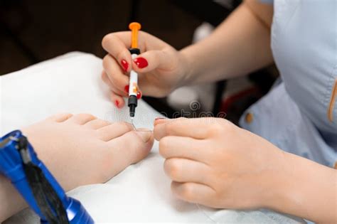 Titanium Thread Or Metal Corrective Brace On The Nail Of The Big Toe