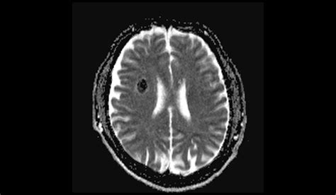 Cavernoma Mri Radiology Article On Cavernous Hemangioma