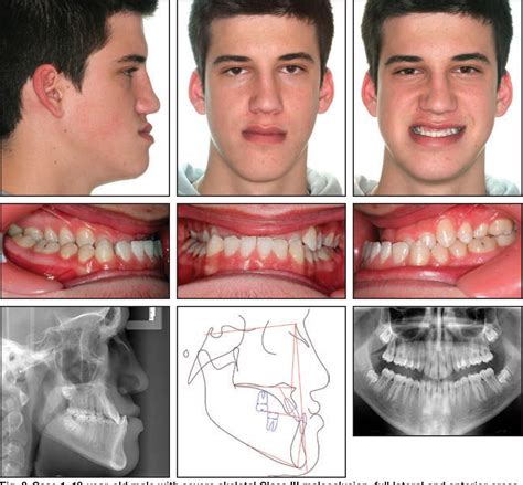 Nonsurgical Correction Of Severe Skeletal Class Iii Malocclusion Semantic Scholar