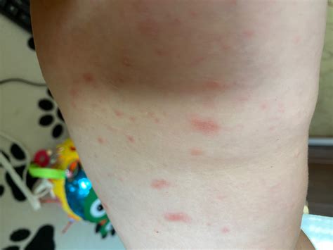 Неизвестная сыпь зудящая по вечерам Вопрос дерматологу 03 Онлайн