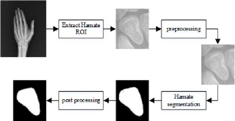 The Process Of The Hamate Bone Segmentation Download Scientific Diagram
