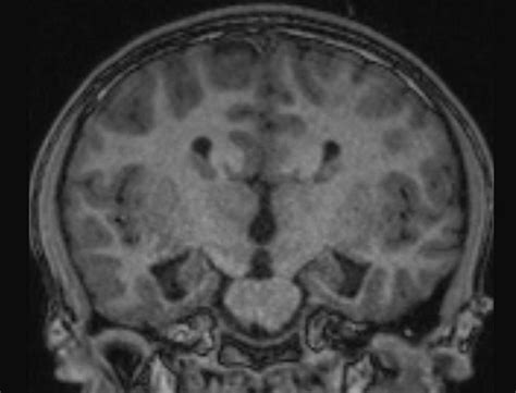 Persistent Craniopharyngeal Canal Neuro Mr Radiology Case Studies
