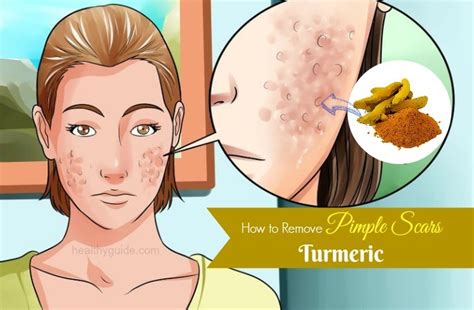 Tips How To Remove Pimple Scars On Nose Chest Back Legs Fast