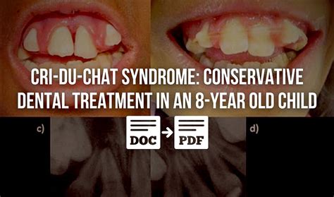 Pdf Cri Du Chat Syndrome Conservative Dental Treatment In An 8 Year