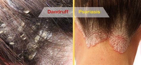 Psoriasis Vs Dandruff Causes Symptoms And Treatments