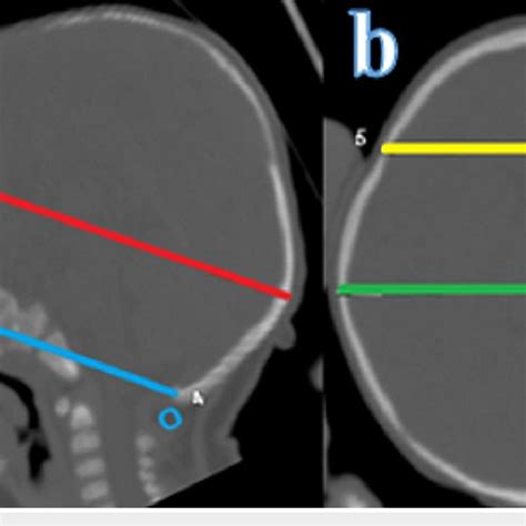Cephalic Index Measurement A Cephalic Index Measurement Plane In Download Scientific Diagram