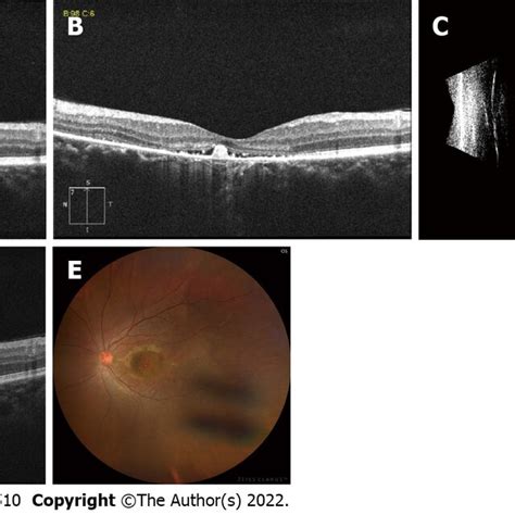 Examination Images After The First And Second Intravitreal Injections