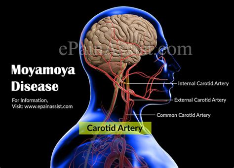Moyamoya Disease Stages Causes Symptoms Treatment