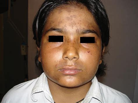 Lichen Planus Actinicus