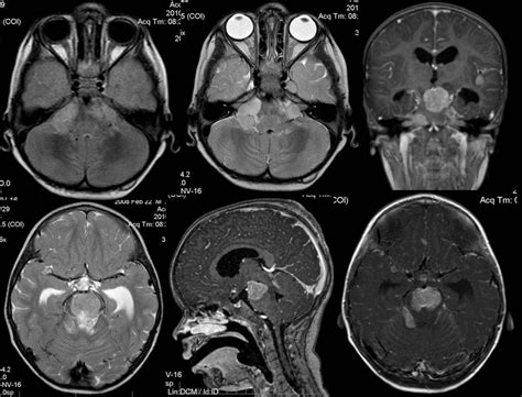 Choroid Plexus Carcinoma Of The Posterior Horn Of The Left Ventricle