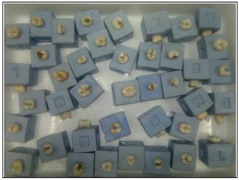 Comprehensive Implementation Of The International Caries Detection And Assessment System Icdas