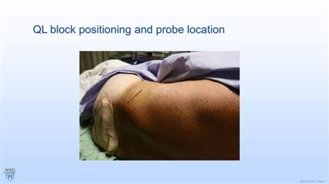 Quadratus Lumborum Block Dr V Koyyalamudi Pptx