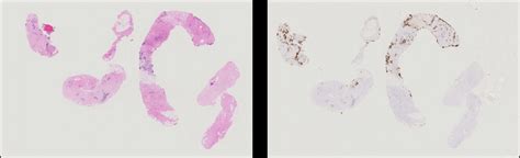 3 H E WSI Left And Its Corresponding IHC WSI Right Thumbnails Download Scientific Diagram