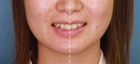 26歳 女性「正中のズレ、”八重歯” を治してほしい」20か月（ 叢生・過蓋咬合） みやび矯正歯科医院