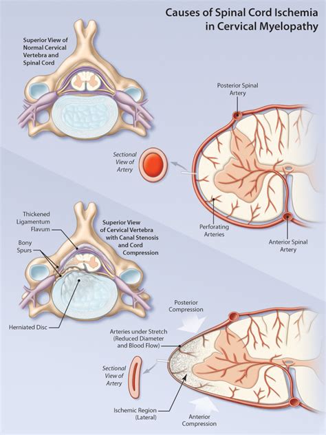 Cord Compression Myelopathy At Anthony James Blog