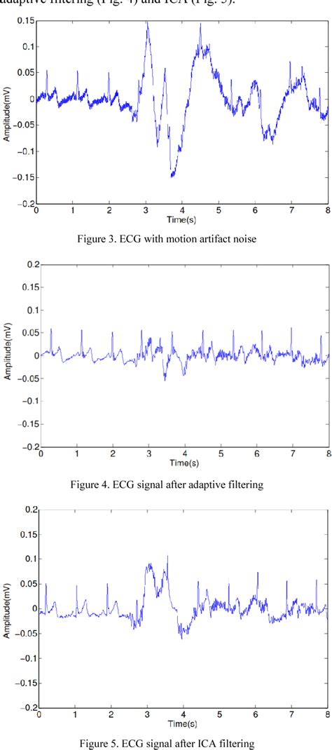 Figure 1 From Simple Method For Adaptive Filtering Of Motion Artifacts