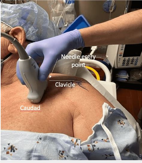 Figure 1 From Comparison Of Supraclavicular Regional Nerve Block Versus Infraclavicular Regional
