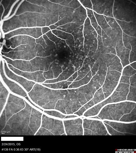 Suspected Multiple Evanescent White Dot Syndrome Retina Image Bank