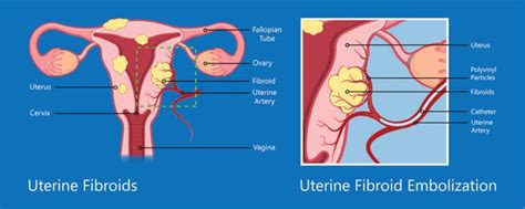 Uterine Fibroids Preferred Fibroid And Vascular Center
