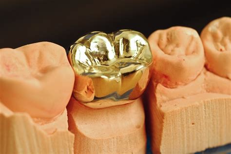 When A Dentist May Recommend A Gold Dental Crown Sarko Dental