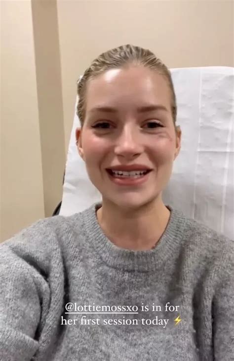 Lottie Moss Gets Face Tattoo Removed After Drunkenly Getting Word Inked