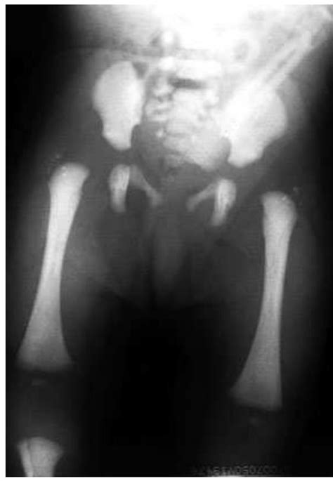 15d Punctuate Calcification In Volving The Hip Joints Is