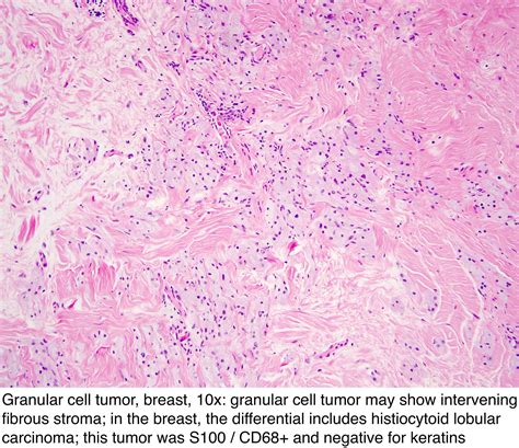 Pathology Outlines Granular Cell Tumor